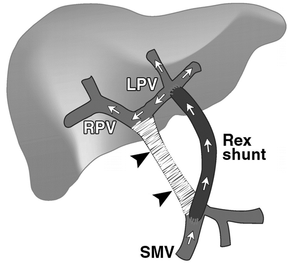 Phẩu thuật Meso-Rex bypass điều trị tắc tĩnh mạch cửa ngoài gan tại ...